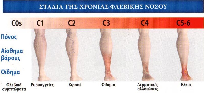Φλεβική ανεπάρκεια – κιρσοί κάτω άκρων* - larissanet.gr